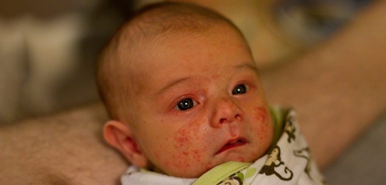 Common Skin Conditions in Newborns - May 2026 | Motherhood Malaysia