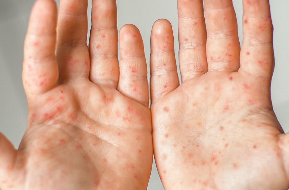 Hand, Foot, and Mouth Disease (HFMD) | Treatments & Prevention