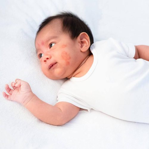 How to Tell if Your Child Has Psoriasis | Motherhood Malaysia