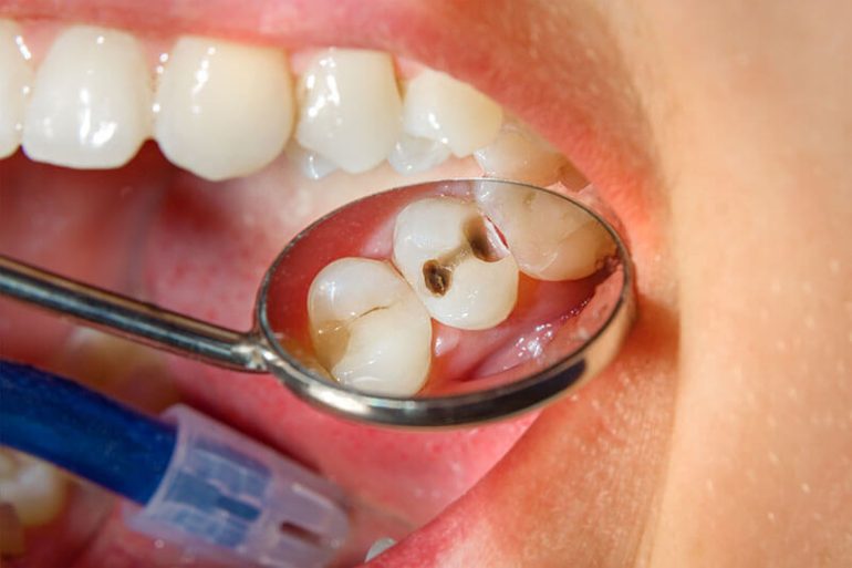 AskMeDoctor! Season 6 Episode 12 | Can Milk Cause Tooth Decay ...