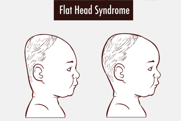 Your Baby Might Have Flat Head Syndrome, Is it Normal? | Motherhood ...