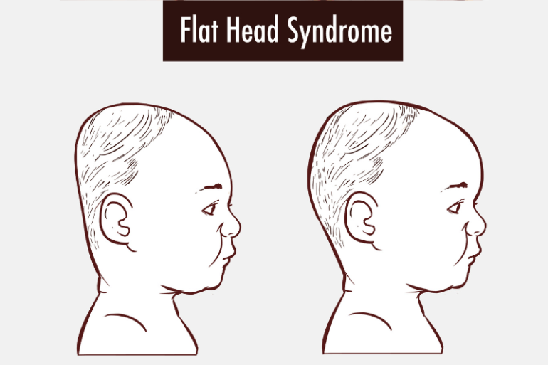 Your Baby Might Have Flat Head Syndrome, Is it Normal? | Motherhood ...