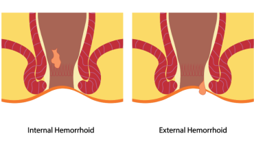 Surprising Truths About Haemorrhoids During Pregnancy (And How to Get ...