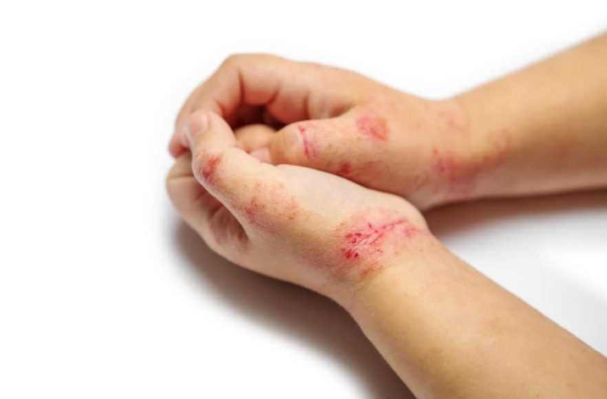 Expert Tells-All: A Parental Guide to Childhood Psoriasis - January ...