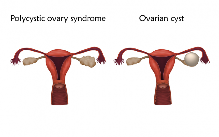 Ovarian Cyst | Penyakit Yang Sering Menjangkiti Wanita di Usia Muda ...
