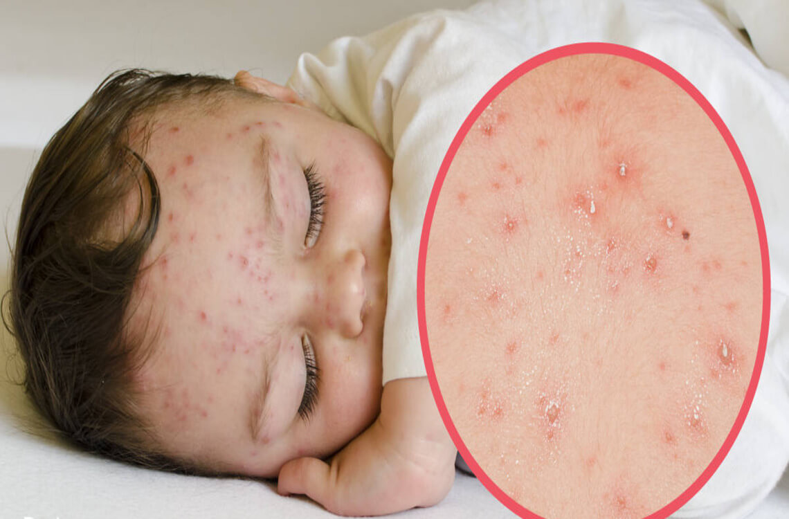 Cacar Air Bayi - Ketahui Gejala, Risiko & Rawatan (2025)