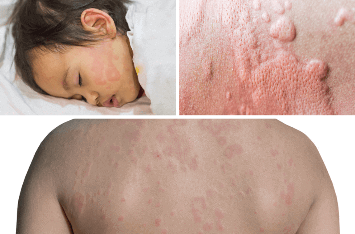 7 Punca Berlakunya Gegata-Seksanya Kulit Anak Gatal Gegata! (2025)