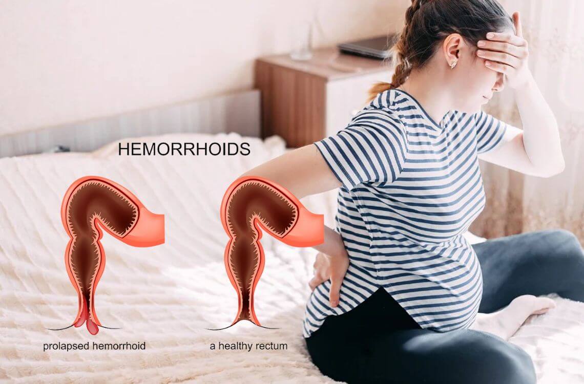 Ketahui Simptom dan 7 Petua Cegah Buasir Ketika Mengandung (2025)