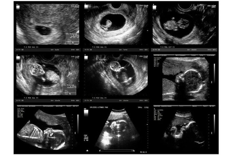Mengapa Ultrasound Scan Penting Ketika Hamil? | Motherhood Malaysia